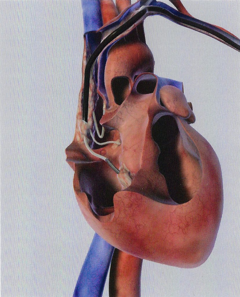 Laser Lead | Florida Electrophysiology Associates